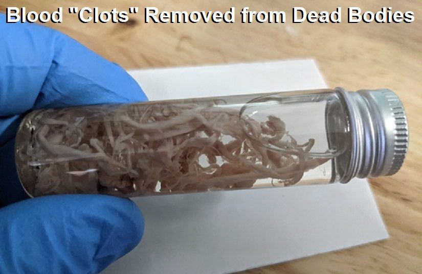 - Funeral Embalmer: 85% of Dead Bodies Now Have Strange Blood Clots ...